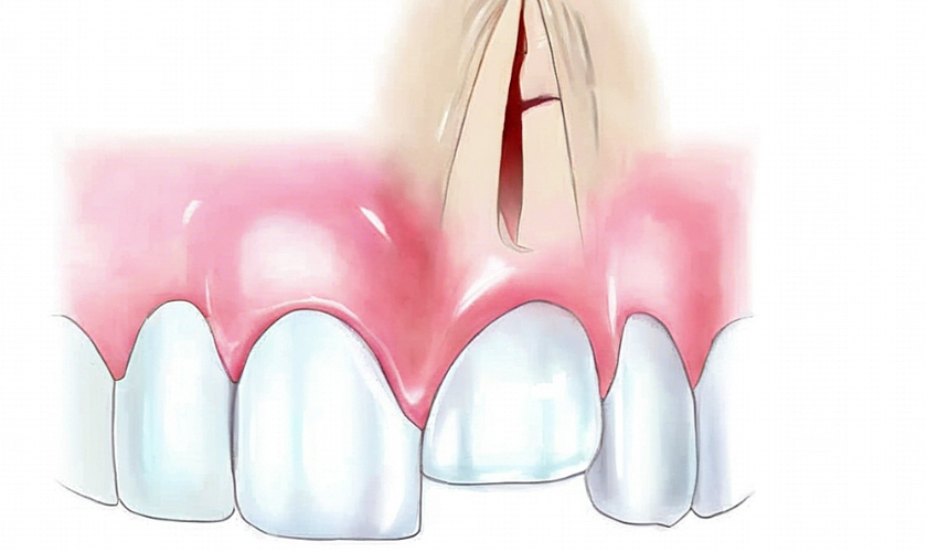 Traumatic Tooth Injuries: What To Do In First 60 Minutes?